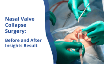 Nasal Valve Collapse Surgery, Before & After Result | Rhinoplasty ...